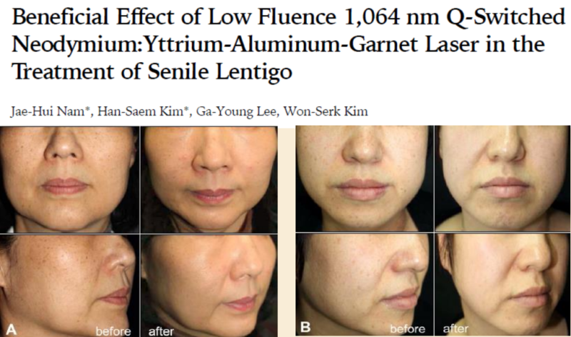Aluguel De Laser Para Peeling Hollywood | Aluguel De Lasers