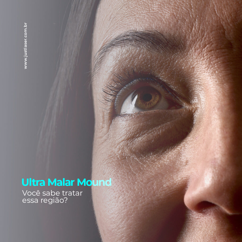 Ultra Malar Mound Você sabe tratar essa região? | Aluguel de Lasers