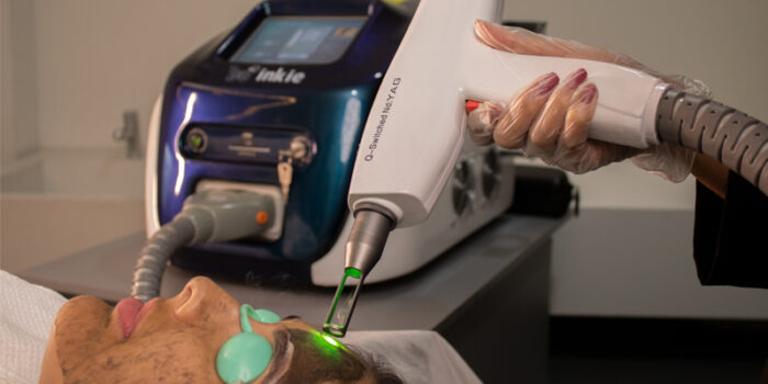 Aluguel do Inkie laser - Laser para remoção de tatuagem | Aluguel de Lasers